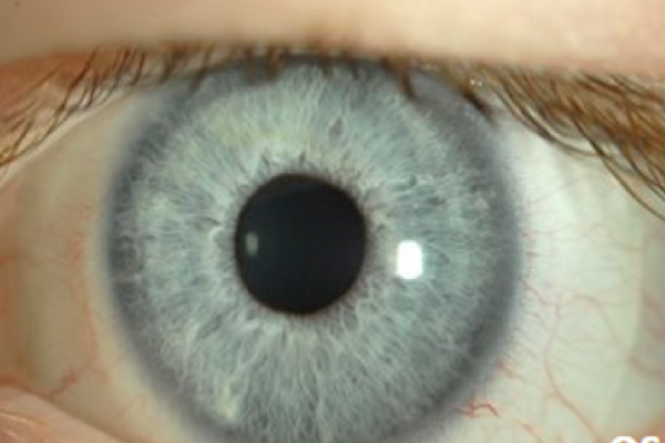 Haunted by Ghosting: HOA Correction in Keratoconus - Contamac