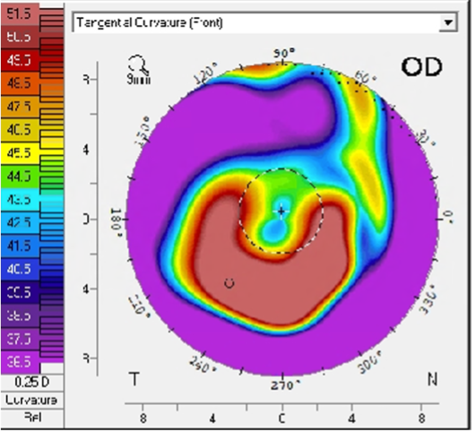 Type 1 Lattice Corneal Dystrophy Status Post Penetrating Keratoplasty ...