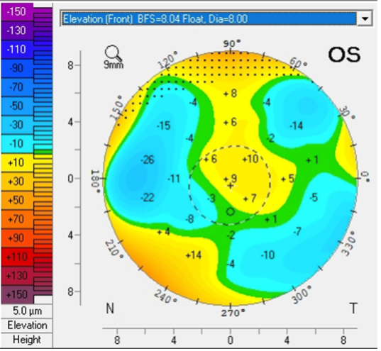 Type 1 Lattice Corneal Dystrophy Status Post Penetrating Keratoplasty ...