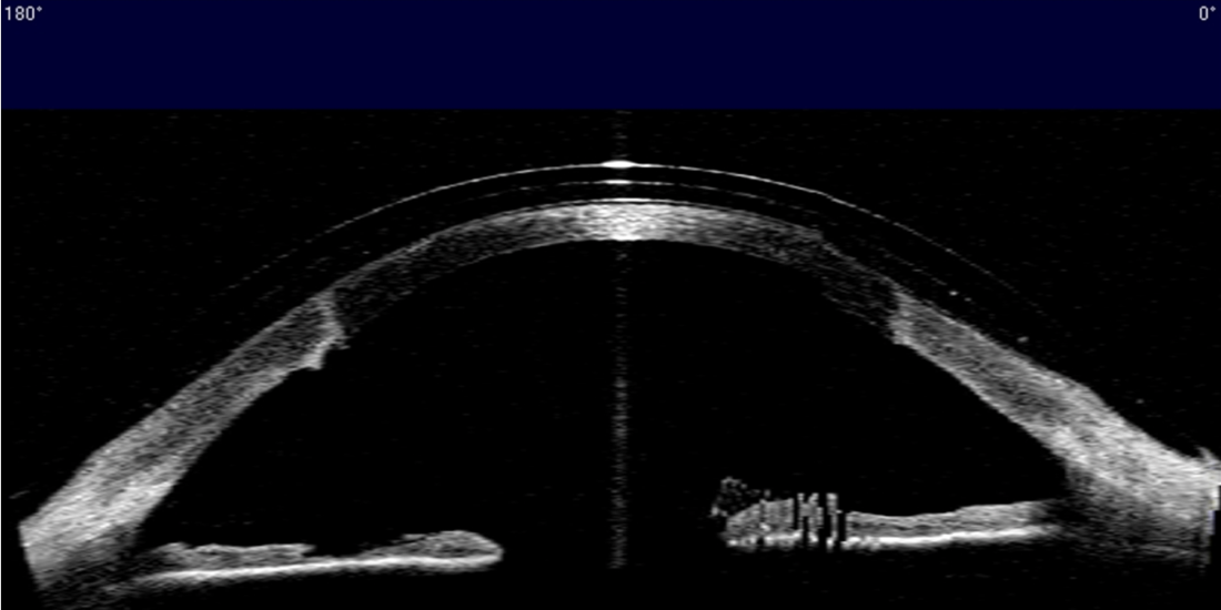 Type 1 Lattice Corneal Dystrophy Status Post Penetrating Keratoplasty ...