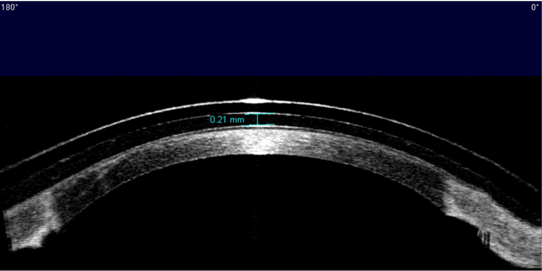 Type 1 Lattice Corneal Dystrophy Status Post Penetrating Keratoplasty ...