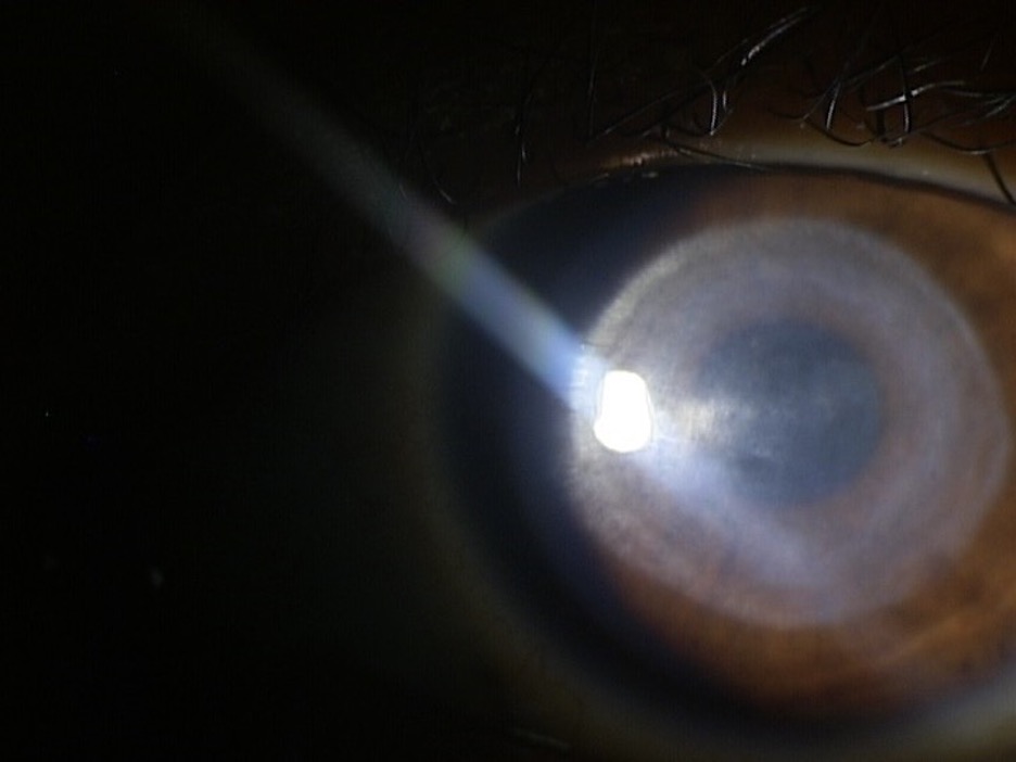 Avoiding a Corneal Transplant in a Young Patient - Contamac