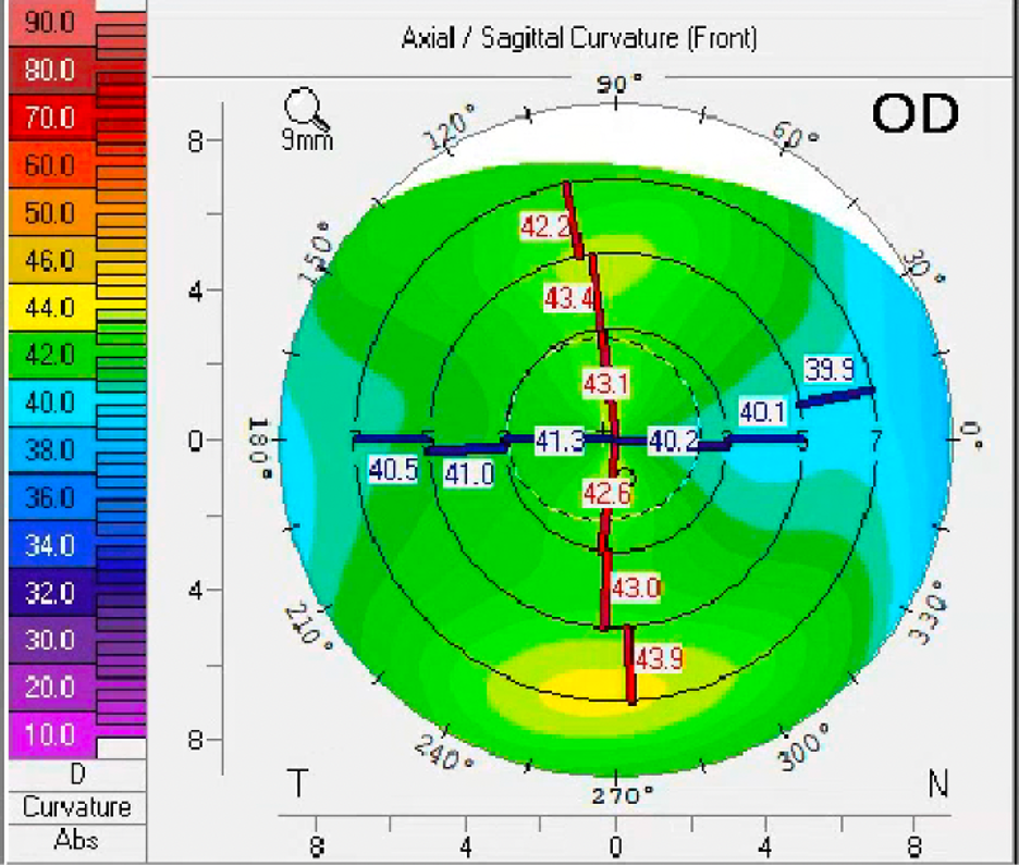 Avoiding a Corneal Transplant in a Young Patient - Contamac