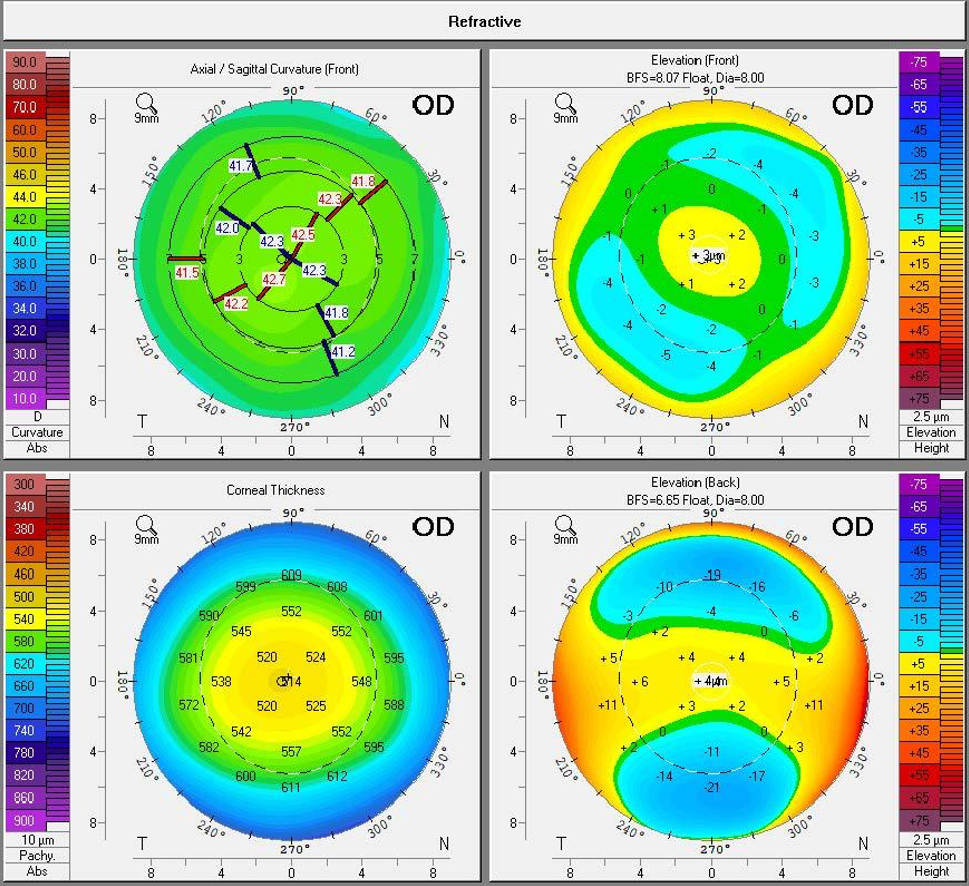 Scleral Lens Management of Soft Contact Lens Induced Limbal Stem Cell ...