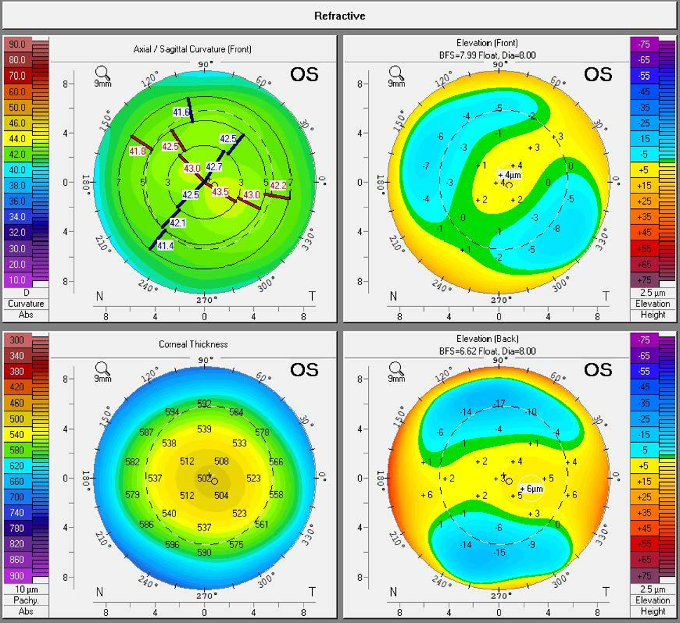 Scleral Lens Management of Soft Contact Lens Induced Limbal Stem Cell ...