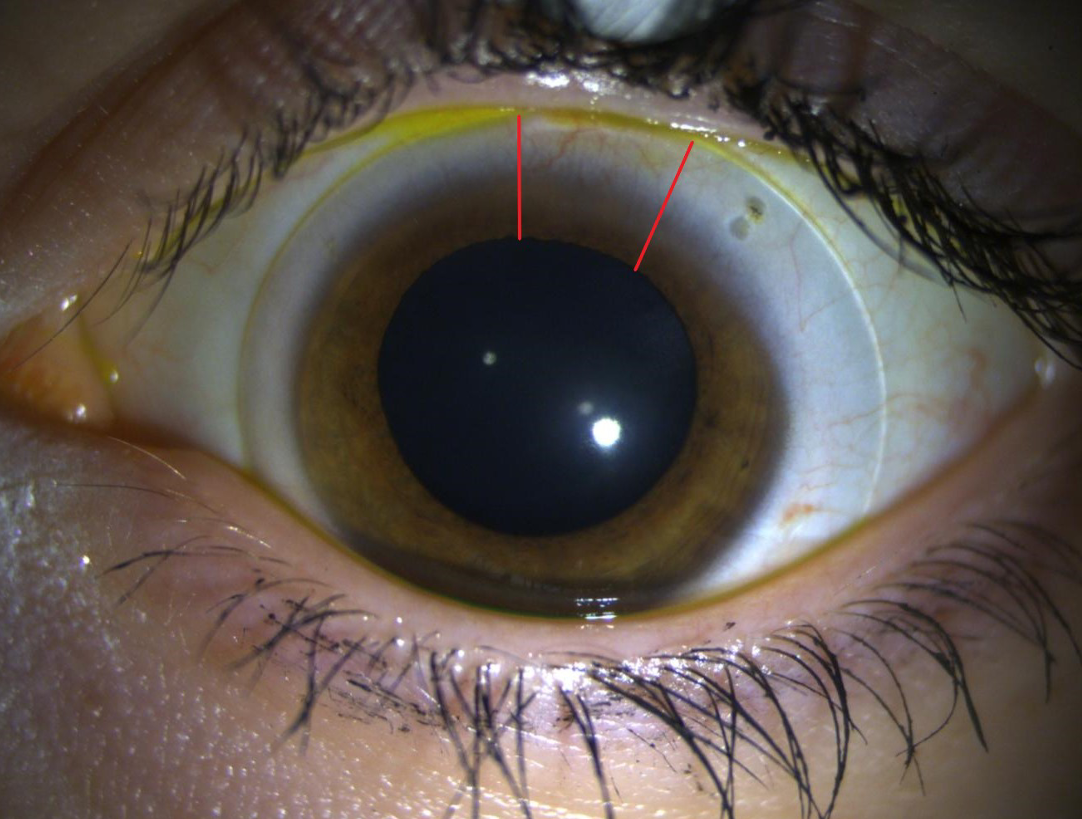 Scleral Lens Management of Soft Contact Lens Induced Limbal Stem Cell ...