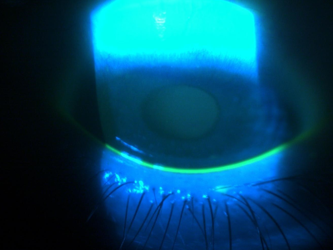 Scleral Lens Management of Soft Contact Lens Induced Limbal Stem Cell ...