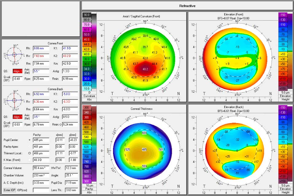 Stage 1 Keratoconus: Great Visual Acuity with Custom Soft Contact Lens ...