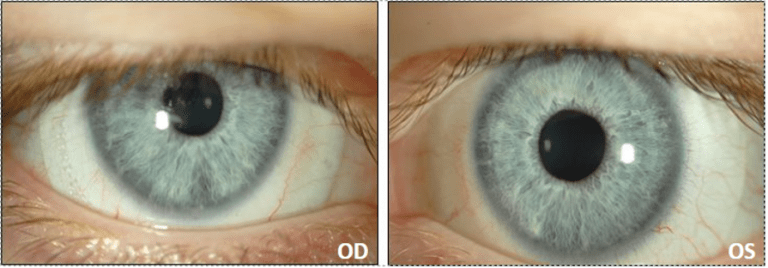 Haunted by Ghosting: HOA Correction in Keratoconus - Contamac
