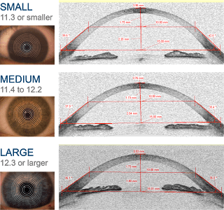 The Effect of Corneal Diameter on Soft Lens Fitting - Contamac