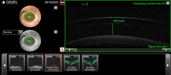 Keratoconus and Scleral Lenses - Contamac