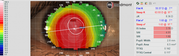 Keratoconus and Scleral Lenses - Contamac