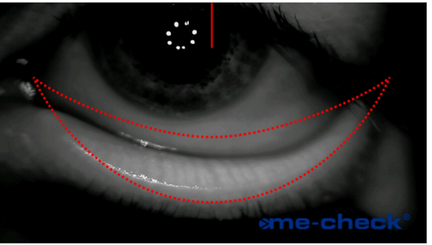 The relationship between Meibomian Gland Dysfunction and Keratoconus ...