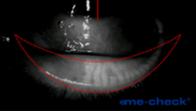 The relationship between Meibomian Gland Dysfunction and Keratoconus ...