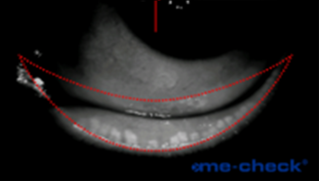 The relationship between Meibomian Gland Dysfunction and Keratoconus ...