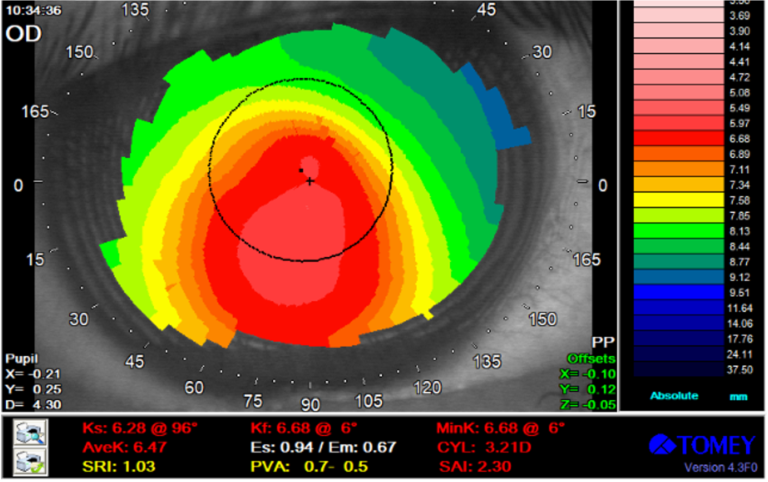 The relationship between Meibomian Gland Dysfunction and Keratoconus - Contamac